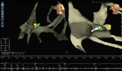 Atrioventricular Av Node Ablation Yellow Dot Is The Tag Of His