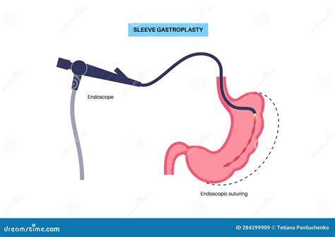 Endoscopic Sleeve Gastroplasty Vector Illustration