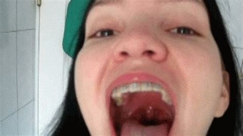 Cool Collection Of My Throat Teeth With Braces B Empire Of Passion