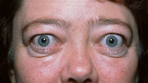 Triamcinolone Offers Relief In Thyroid Eye Disease