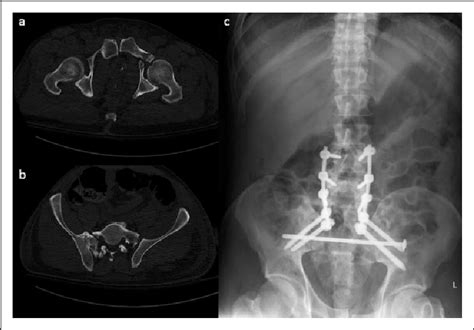 Sacral Fracture With M3 Modifier A Axial Ct Shows Anterior Pelvic