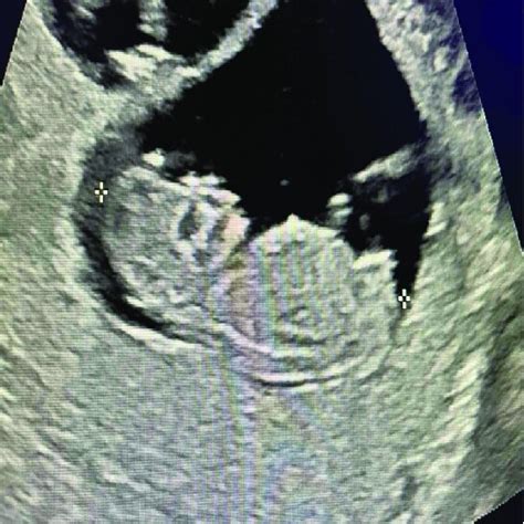 Fetal Anencephaly Ultrasound Encephalic Deficit Depiction Download