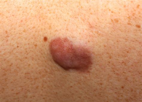 Dermatofibrosarcoma Protuberans Causes Staging Treatment