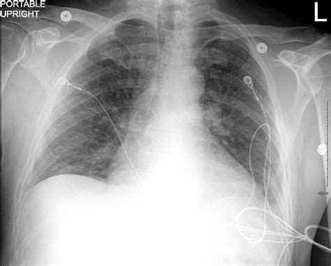 Cxr Interstitial Edema The Common Vein