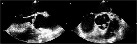 The Patients Transesophageal Echocardiogram From Long A And Short Download Scientific