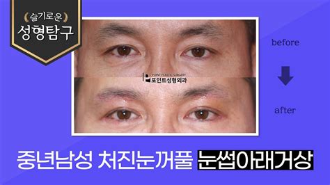 눈성형수술전후 중년남성 처진눈꺼풀 눈썹아래거상 Youtube