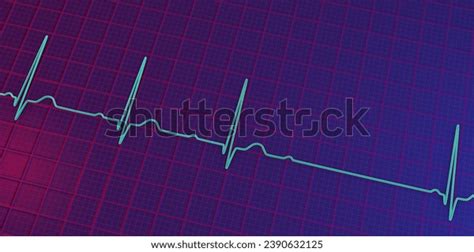 3d Illustration Visualizing Ecg 2nd Degree Stock Illustration 2390632125 Shutterstock