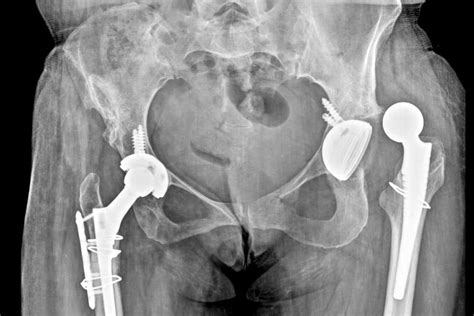 Hip Dislocation Abhaychallani