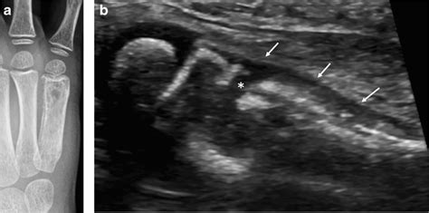 Ewing Sarcoma In An 8 Year Old Girl The Patient Presented With Download Scientific Diagram