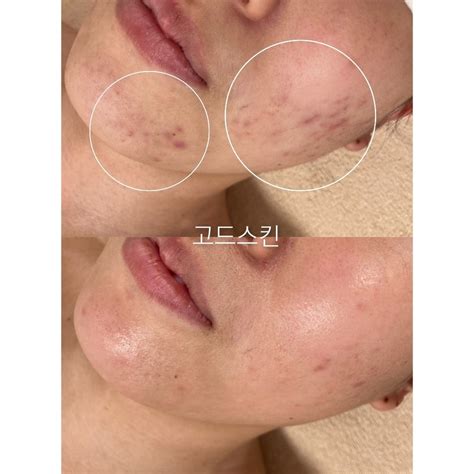 여드름여드름흉터여드름색소침착모공홍조리프팅 고드스킨에서 해결해드려요💞 대전광역시 서구 괴정동 피부관리 당근 비즈 소식