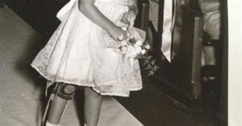 As A Polio Survivor Im Part Of A Dying Breed — Maybe