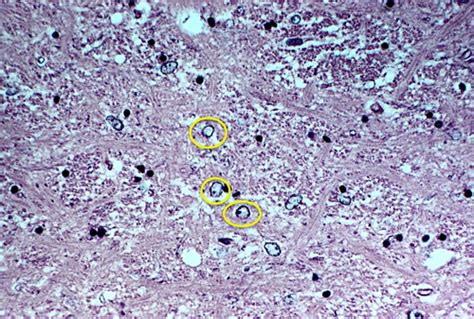 Neuropath 5 Gen Path Flashcards Quizlet