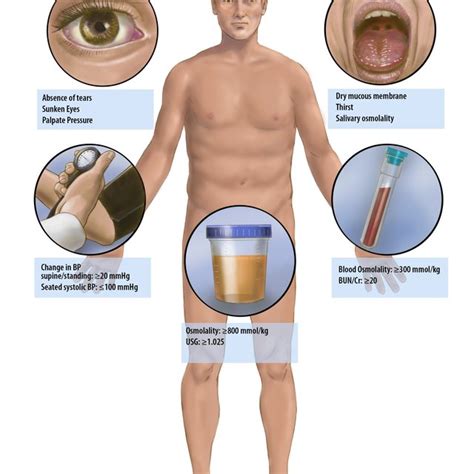 PDF Diagnosing Dehydration Blend Evidence With Clinical Observations
