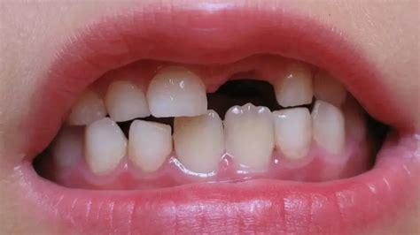 การตีความความฝันเกี่ยวกับการล้มของฟันซี่เดียวโดย Ibn Sirin และ Al Nabulsi การตีความความฝัน