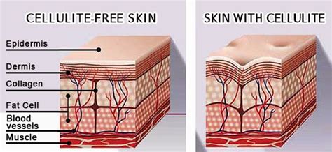 Healthylife Cellulitis Treatment Natural Safe And Painless System