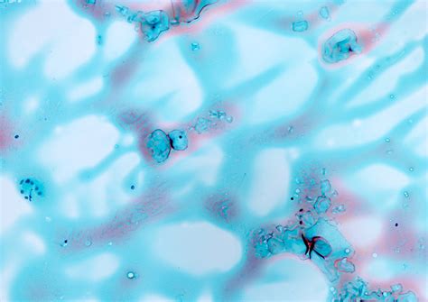 Colloid Thyroid