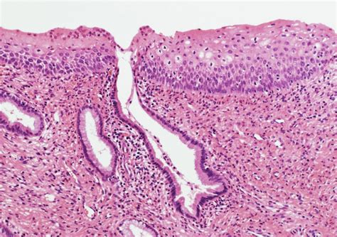 Normal Transformation Zone Histology Cervix Cervix