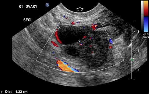 Mucinous Cystadenoma Ultrasound