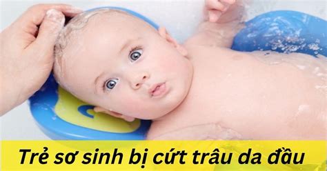 Top 14 Mẹo Trị Cút Trâu Cho Bé Mới Nhất Năm 2023 Eu Vietnam Business Network Evbn