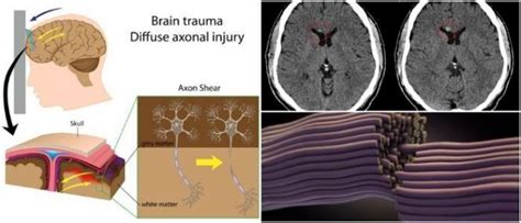 Diffuse Axonal Injury Causes Symptoms Diagnosis And Treatment Diffuse Axonal Injury Causes Symptoms Diagnosis And Treatment