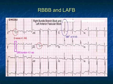 Right Bundle Branch Block