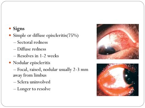 1168episcleritis And Scleritispdf Fir Jrs Pdf