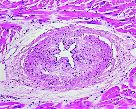 Coronary Artery Pathology Heart