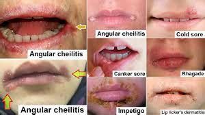 A Recent Paper On Angular Cheilitis Dentist Isle Of Man