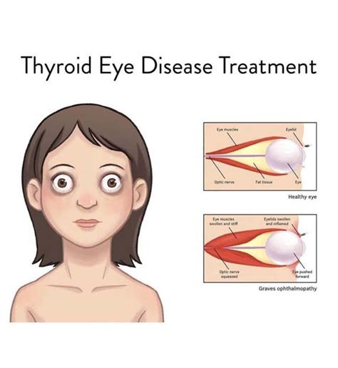 Hyperthyroidism Eyes