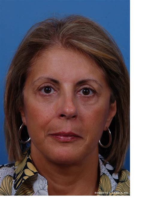 Chin Augmentation Before And After 07 Contoura
