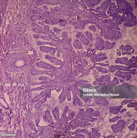 피부 생검 두피 암종 색소 침착 기저 세포 암종 태양의 가장 일반적인 유형은 피부암을 유도했다 생검에 대한 스톡 사진 및 기타 이미지 Istock