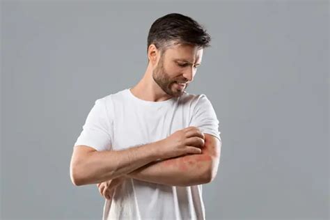 Tratamiento De La Dermatitis Atópica