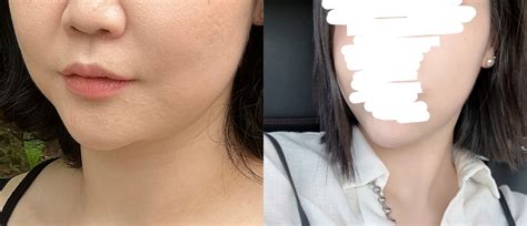 파워v이중턱 앞볼 팔자 얼굴지방흡입 민트실리프팅 사각턱보톡스 11개월차 내돈내산 후기 닥터정 리반의원