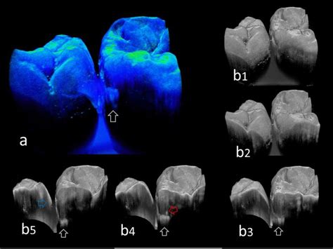 Promising Imaging Method For The Early Detection Of Dental Caries Bite Magazine