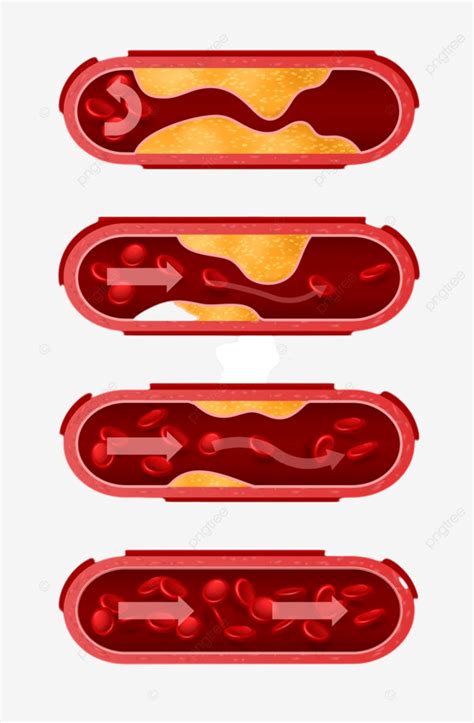 죽상동맥경화증 동맥혈 콜레스테롤 침착 빨간 막히다 질병 Png 일러스트 및 벡터 에 대한 무료 다운로드 Pngtree