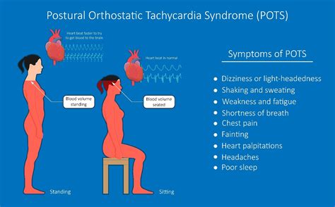 Treatment For Postural Orthostatic Tachycardia Syndrome Using Natural