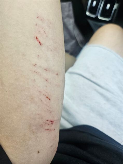 상처 소독 지식in