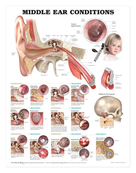 Ear Anatomy Chart Middle Ear Conditions Science Kits