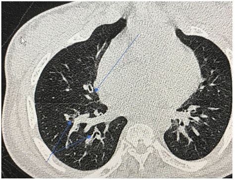 Cross Sectional Thoracic Ct Scan Shows Bronchial Dilation And Early Download Scientific Diagram