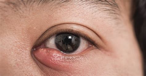 Qué Son Y Por Qué Salen Orzuelos En Los Ojos Infección Bacteriana