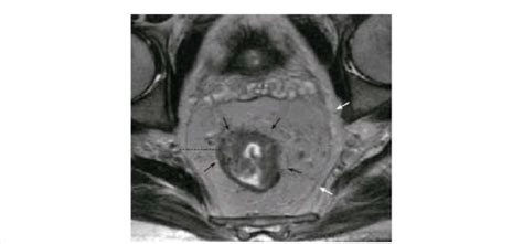 Mri Of Rectal Cancer With Demonstration Of Circumferential Resection