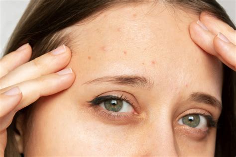 Acne Eczema Hives Your Complete Guide To Skin Conditions
