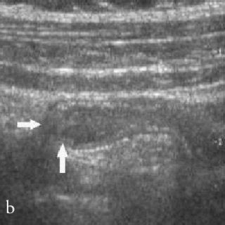 US Images Of The Normal Appendix Show A Transverse And B Download Scientific Diagram