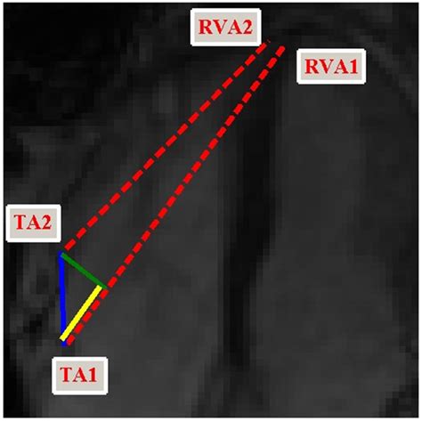 Calculation Of Proposed Parameters Demonstrated On End Diastole And Download Scientific Diagram