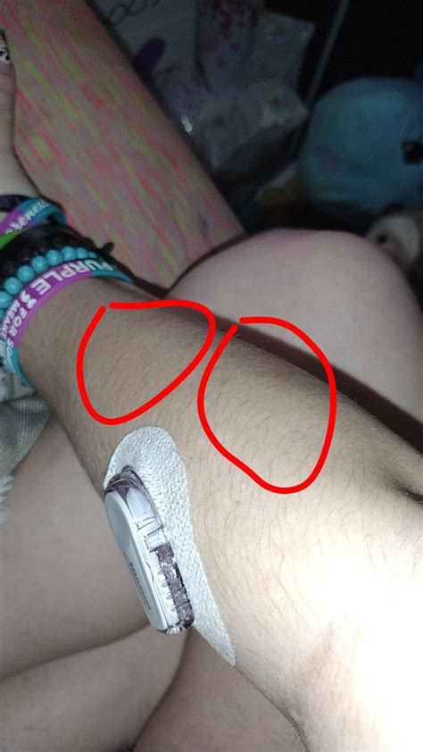 Omnipod And Dexcom Users R Dexcom