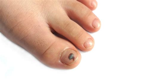 What Do Black Toes Indicate