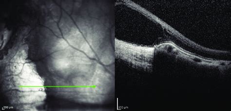 OCT Section Through The Macula Displaying Fluid In The Sub Intercalary Download Scientific