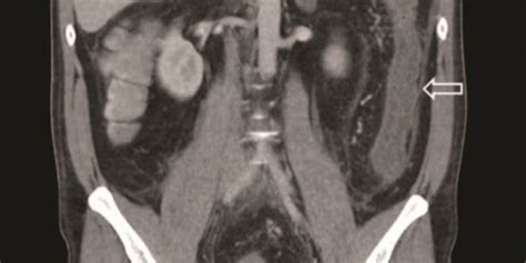 Extensive Mesenteric Lipodystrophy Of The Left Colon Case Report And