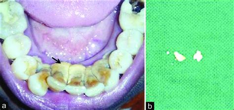 A Intraoral Photograph Showing Dental Calculus On Lingual Surface Of