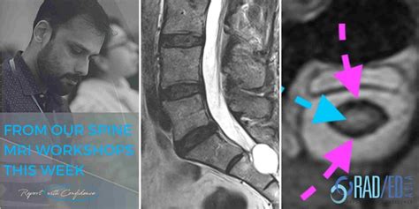 Schmorls Nodes Spine Mri Online Radiology Course Learn Key Points